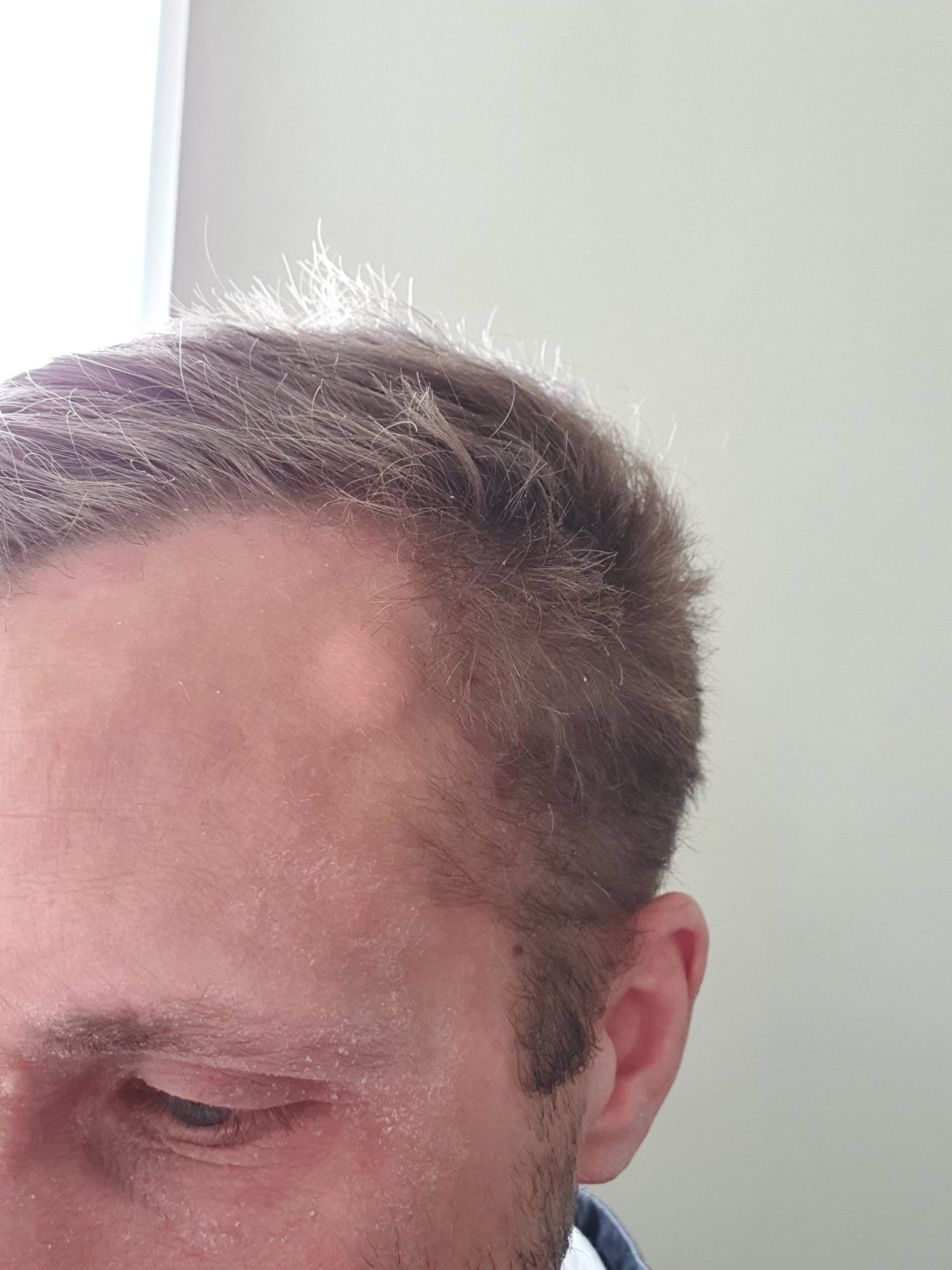 Forehead Cyst Removal | Private Same-Day Treatment