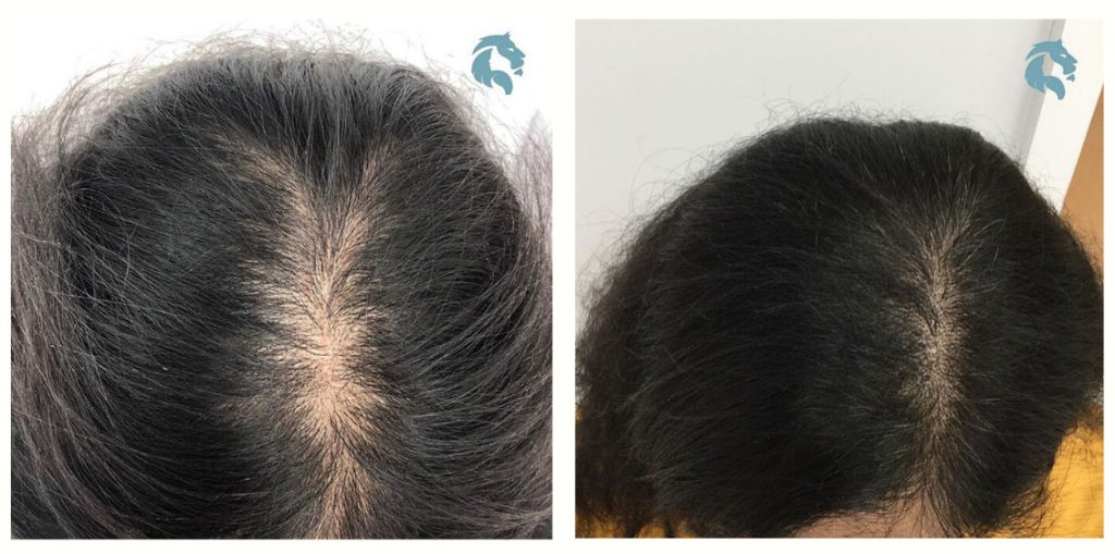 What is PRF Hair Treatment? Does It Really Work?
