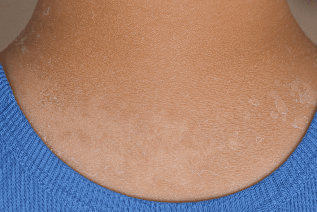 Skin Pigmentation and Discolouration Disorders - Aventus Clinic