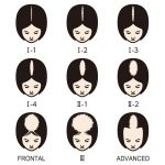 The Stages of Balding and Treatment Options - Aventus Clinic