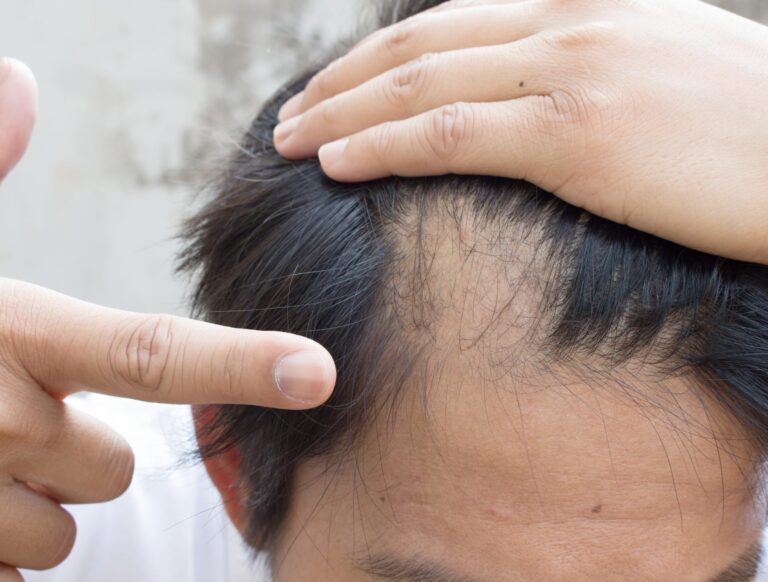 Early Signs of Hair Loss: How to Tell If You're Going Bald