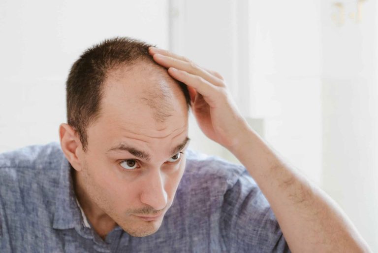 The Stages of Balding and Treatment Options - Aventus Clinic