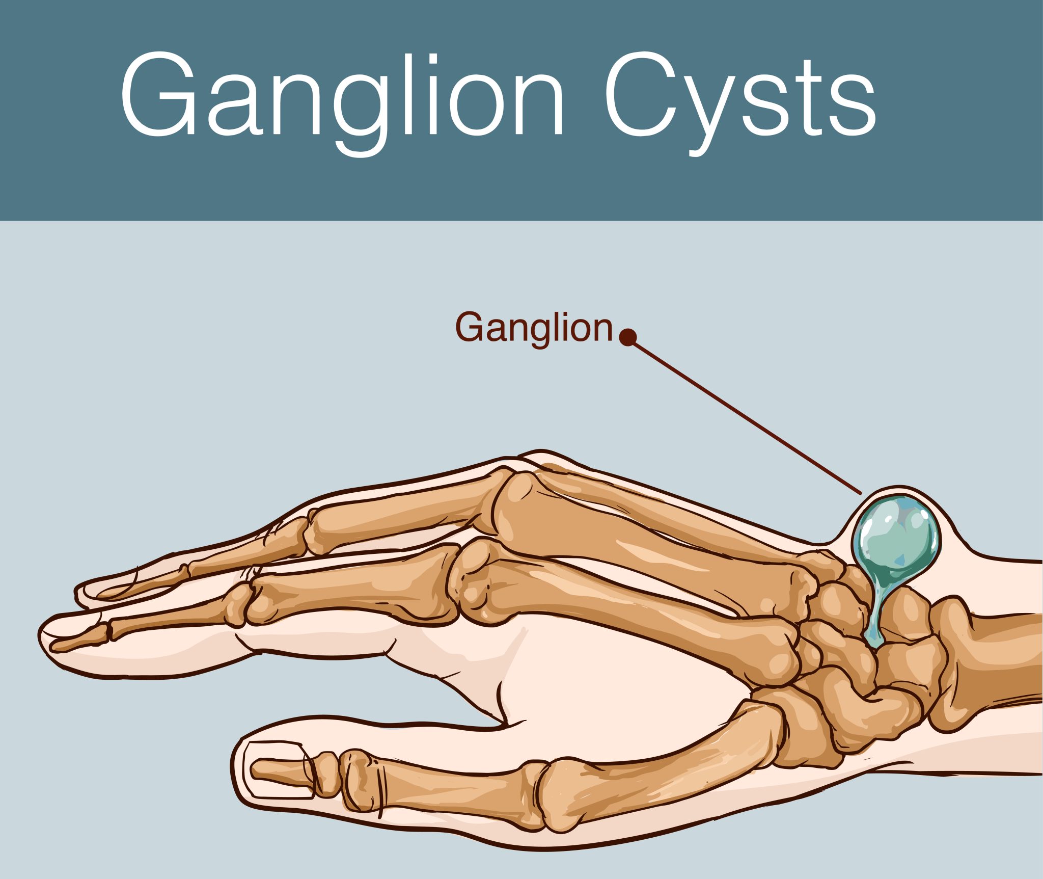 The Relationship Between Ganglion Cysts and Vitamin D Deficiency ...