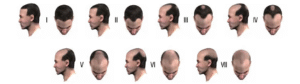 Do You Have A Mature Hairline: Everything You Need To Know