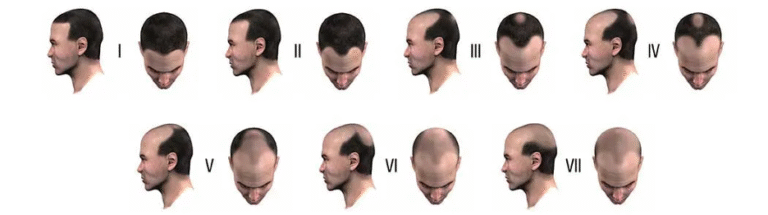 Do You Have A Mature Hairline: Everything You Need To Know