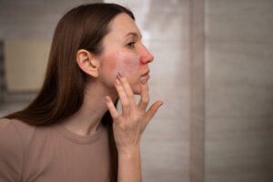 Why Is My Face Always Red? Common Causes & Treatments | Aventus Clinic