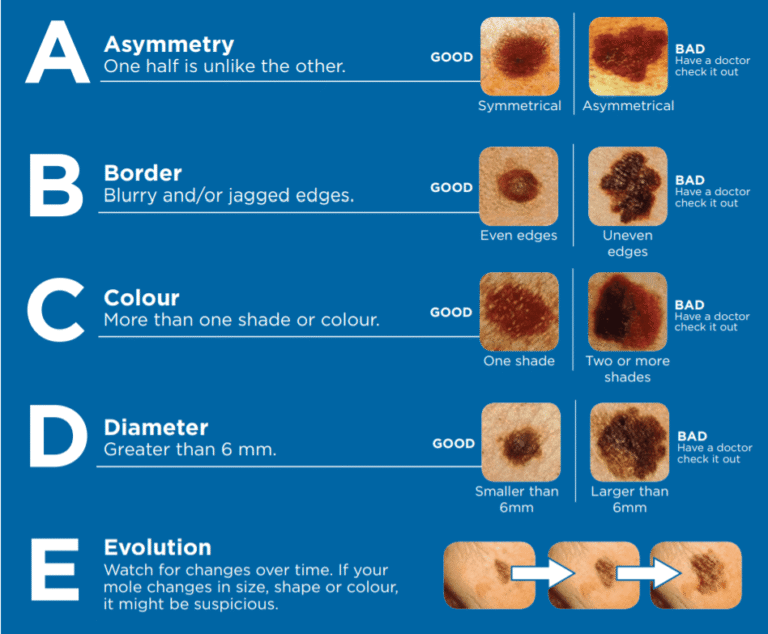 Red Mole on skin: How to Tell Cherry Angioma from Melanoma