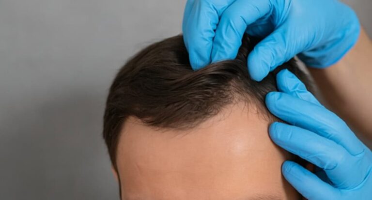 Elon Musk Hair Transplant: Musk's Receding Hairline and Transformation