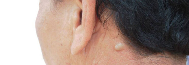 Popping a Sebaceous Cyst - Can I Burst a Sebaceous Cyst at Home ...