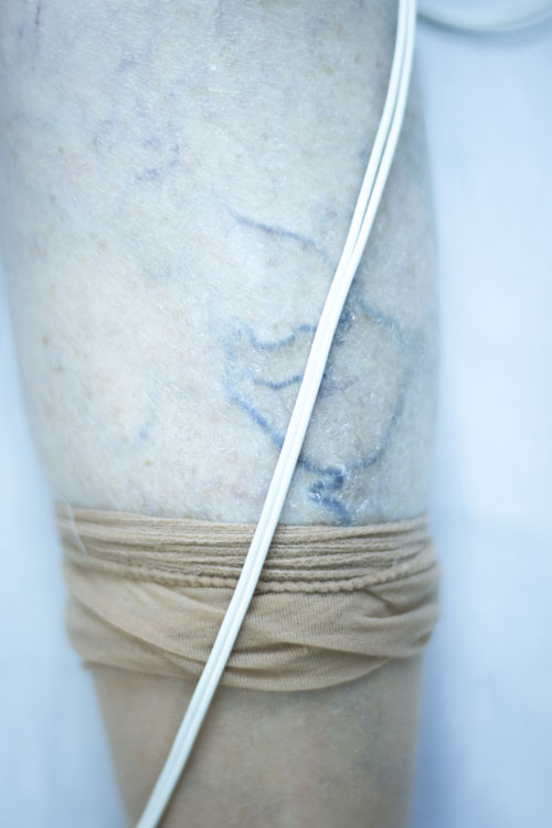 Thread Vein Removal in London | From £250 | Aventus Clinic