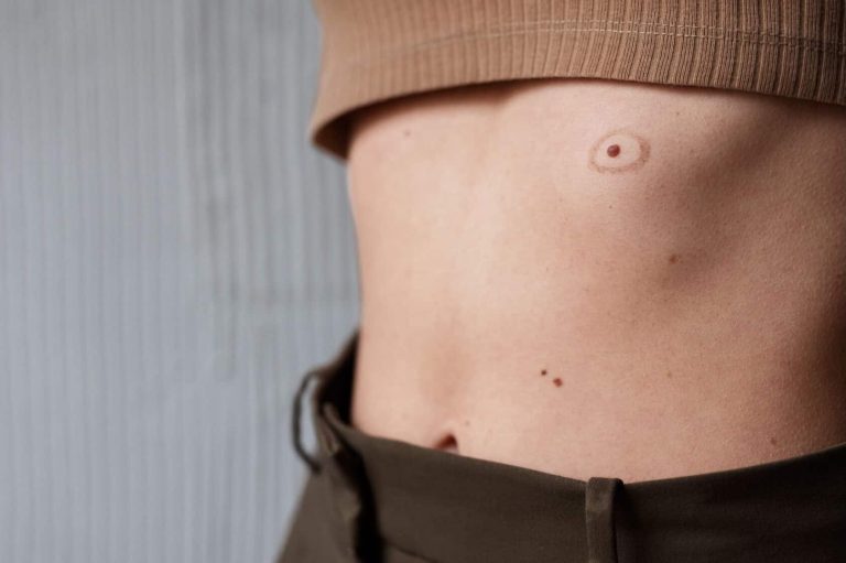 Red Mole on skin: How to Tell Cherry Angioma from Melanoma