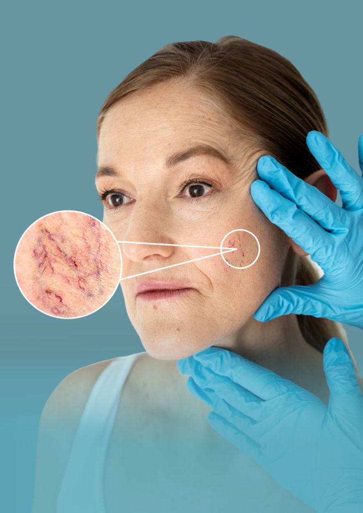 Facial Thread Vein Removal | Same Day - £250 | Aventus Clinic
