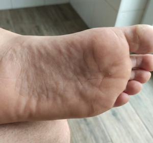 Verruca: Diagnosis, Cause and Treatment | Aventus Clinic