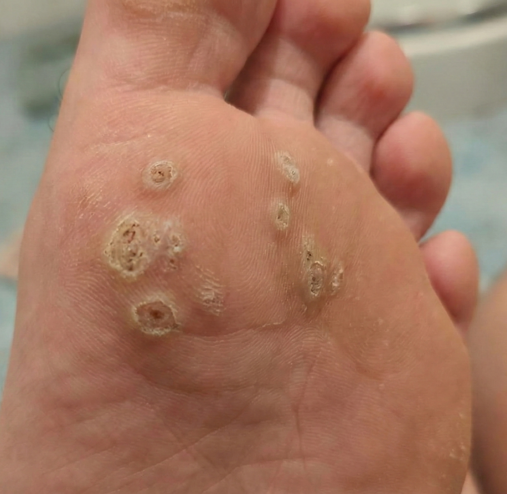 Verruca: Diagnosis, Cause and Treatment | Aventus Clinic