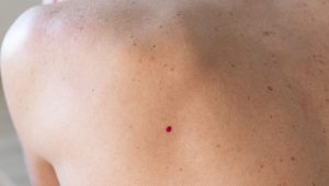 Red Mole on Skin: How to Tell Cherry Angioma from Melanoma