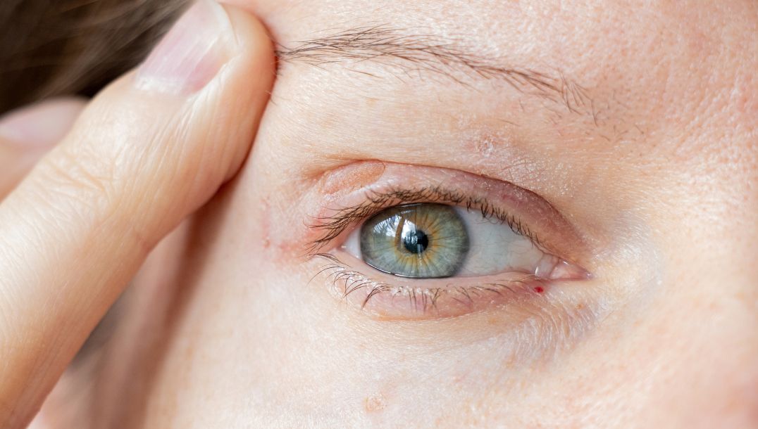 Droopy Eyelid - Causes, Symptoms & Treatment