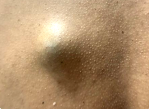 What Does a Cyst Look Like? Pictures of Different Types of Cysts
