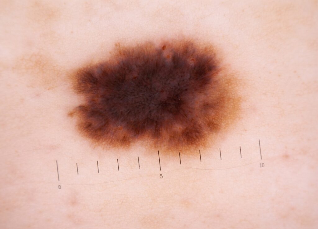 Melanoma Skin Cancer: Signs, Causes & Treatment Options