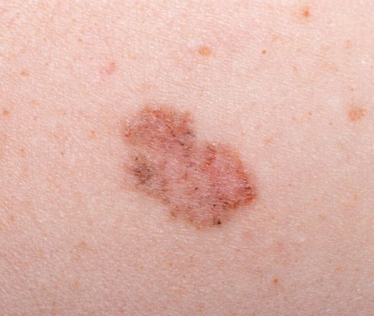 Basal Cell Carcinoma (BCC): Symptoms, Causes & Treatment