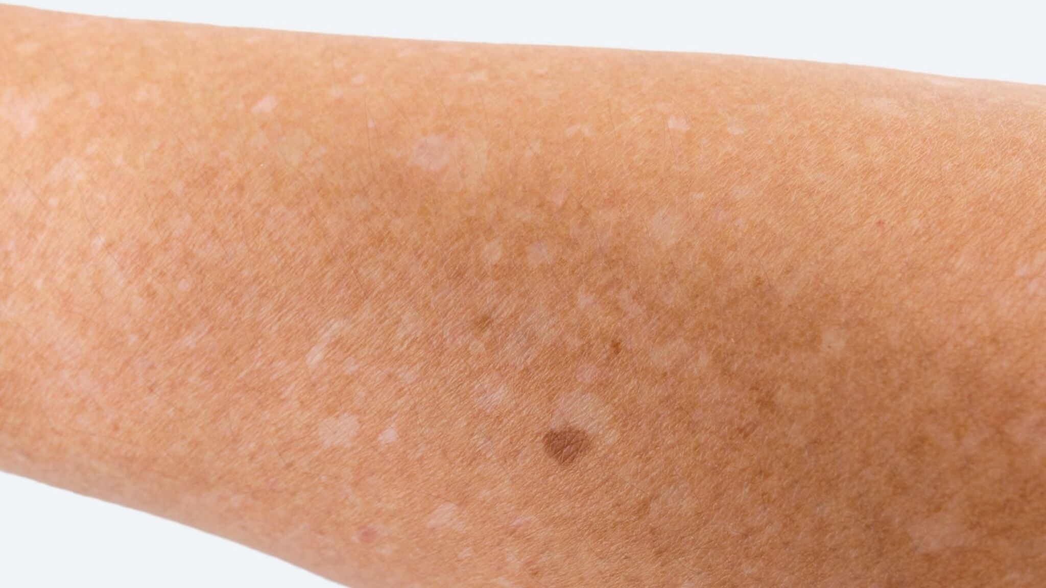 White Spots on Skin: 6 Common Causes & When to See a Doctor