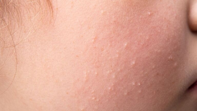White Spots on Skin: 6 Common Causes & When to See a Doctor